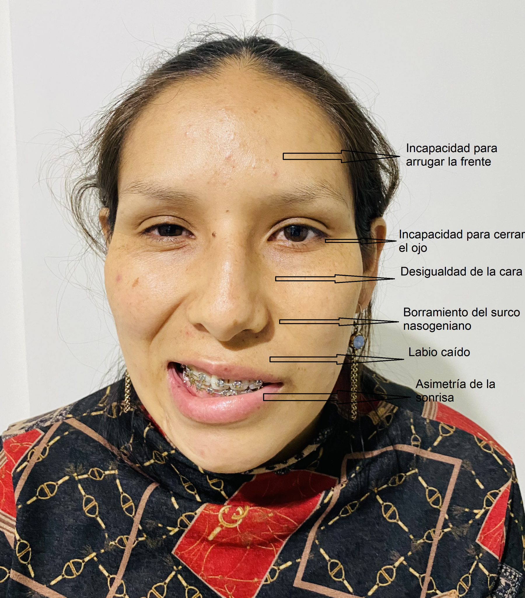 Tratamiento de parálisis facial en Lima | Dr. Marcelo Espinoza